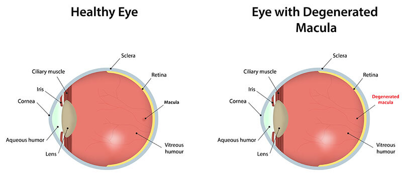 Photodynamic Therapy Inland Valley Retina